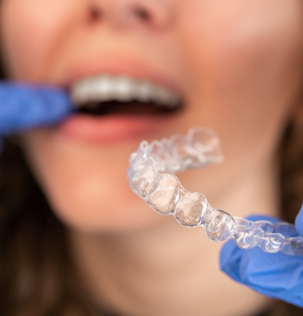 Orthodontiste spécialisé en gouttières invisalign® | Smile Clinique ...